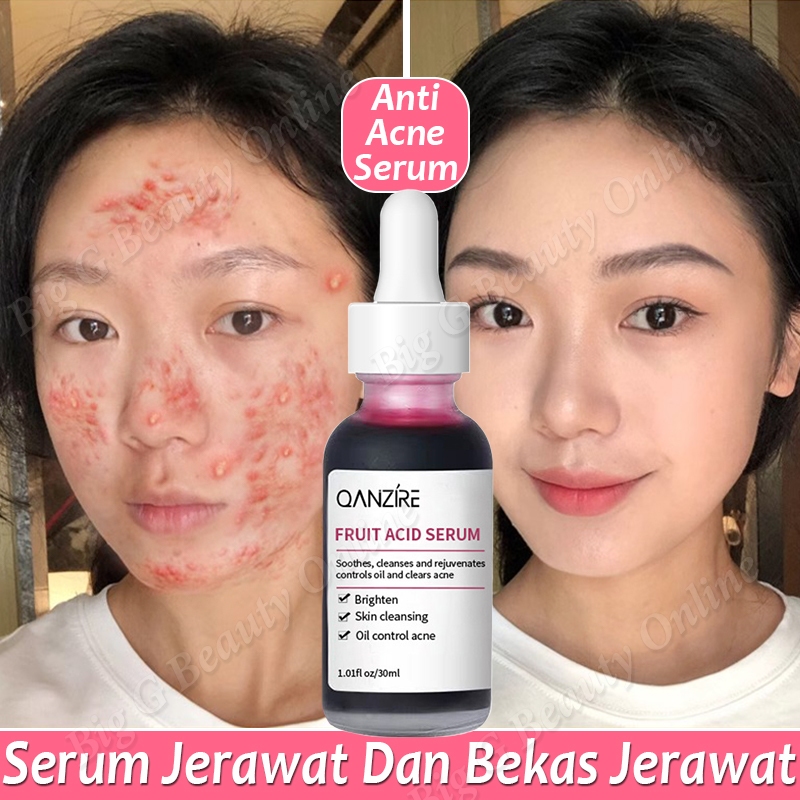 Jual Serum Jerawat Dan Bekas Jerawat Mengecilkan Pori Pori Wajah Serum ...