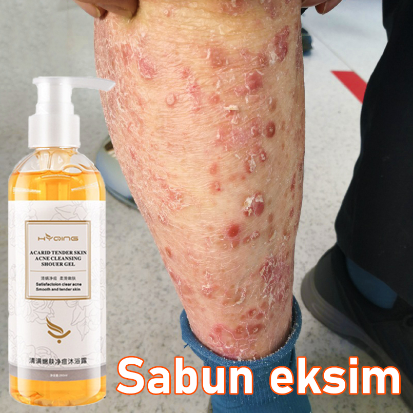 Jual Sabun gatal kulit ampuh Sabun mandi gatal kulit ampuh sabun ...