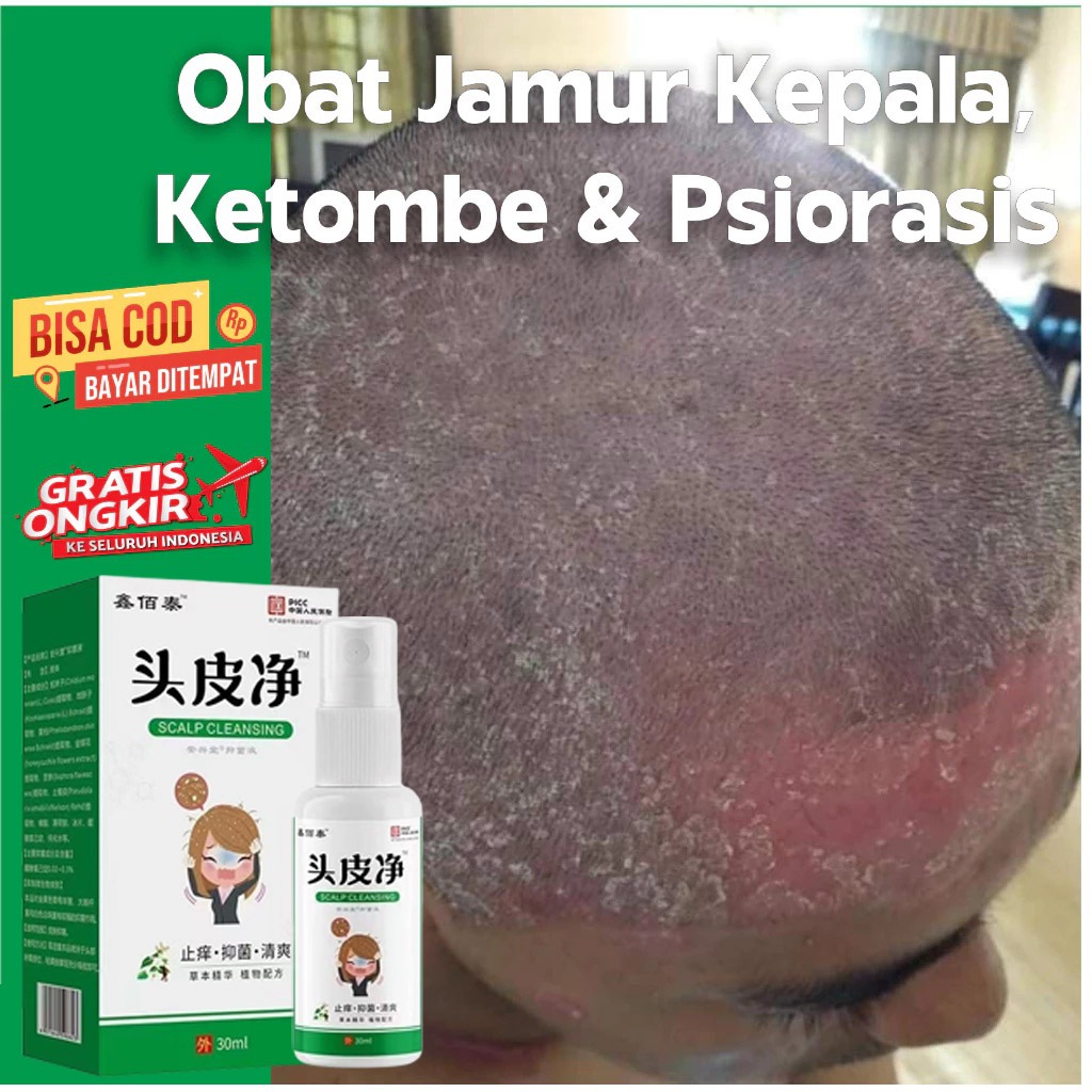 Jual Obat Gatal Kulit Kepala 30ml Original Obat Anti Ketombe Basah Kering Kerak Psoriasis Gatal ...