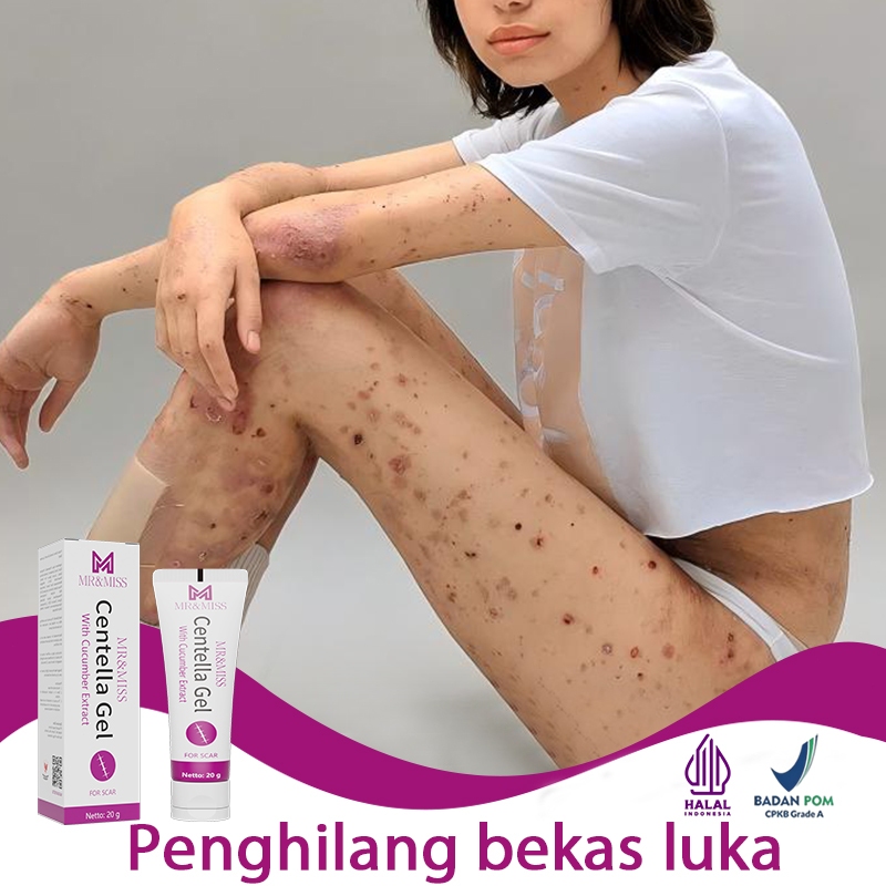 Jual Cream penghilang bekas luka salep luka bakar obat keloid ...