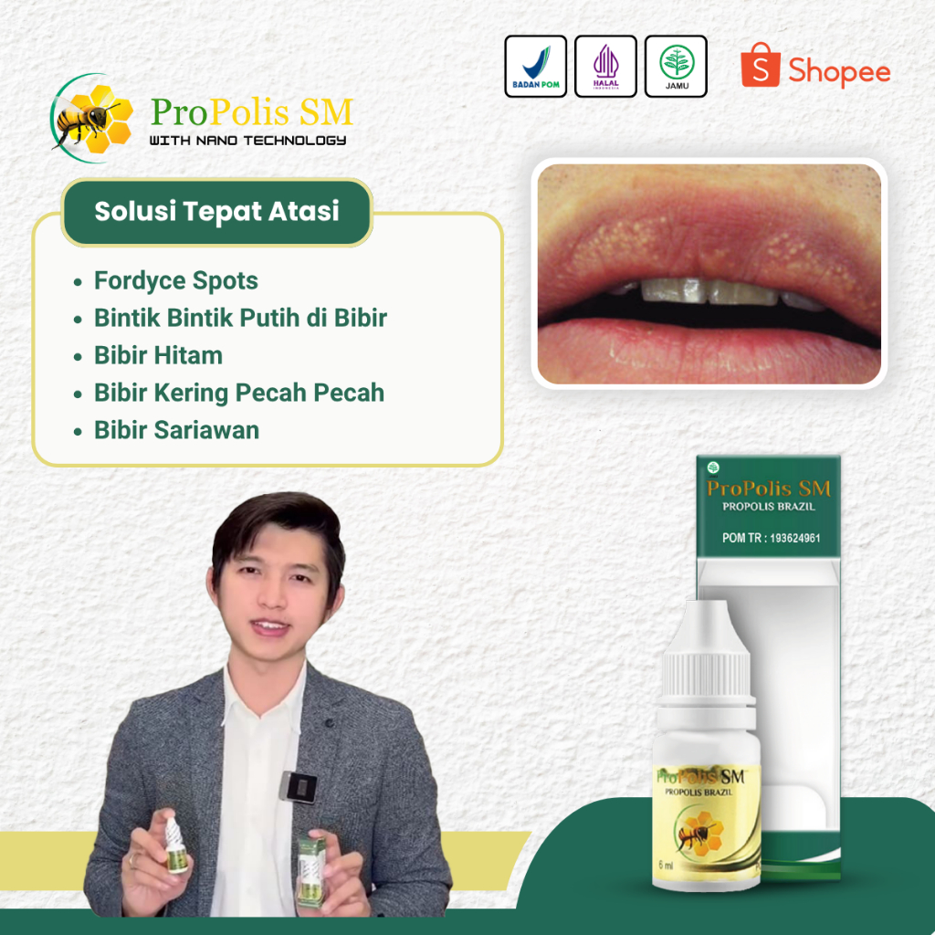 Jual Obat Fordyce Spots Oles, Penghilang Bintik Putih di Bibir, Bibir ...