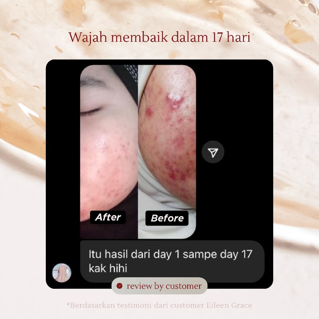 Jual EILEEN GRACE - Active Acne Treatment Bundle | Rose Jelly Mask ...
