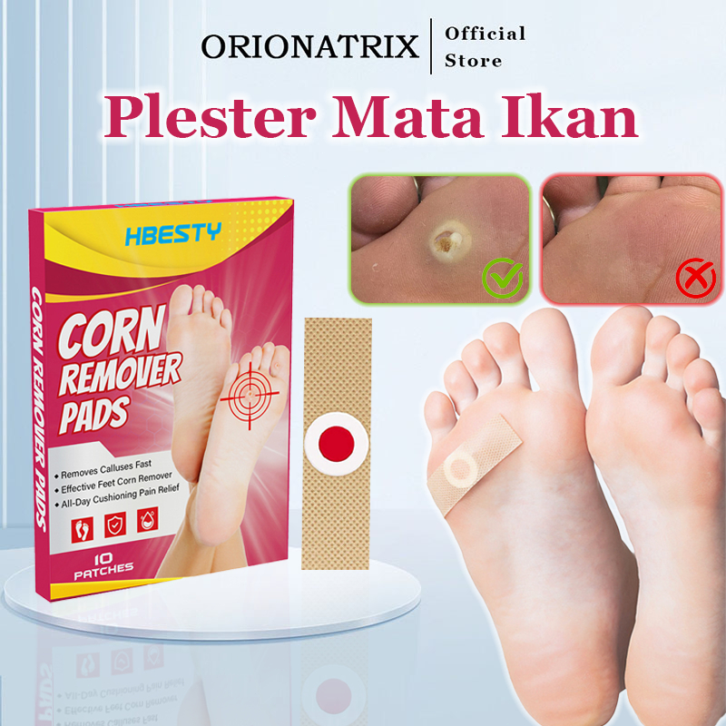 Jual Orionatrix Plester Mata Ikan Paling Ampuh Obat Mata Ikan Kaki ...