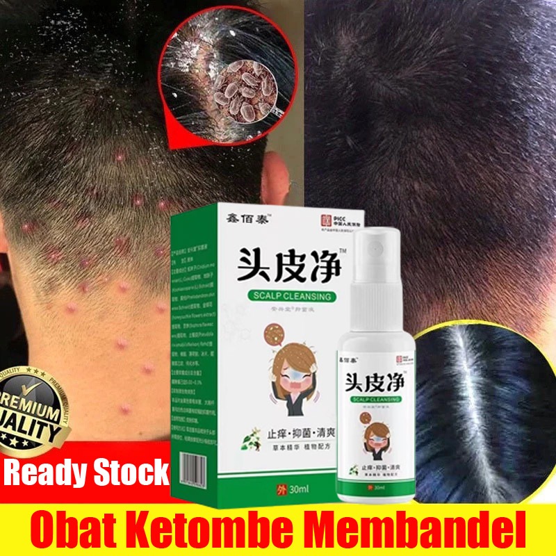 Jual Obat Ketombe Membandel, Kepala Gatal, Ketombe Berkerak, Kulit Kepala Koreng, Kulit Kepala ...