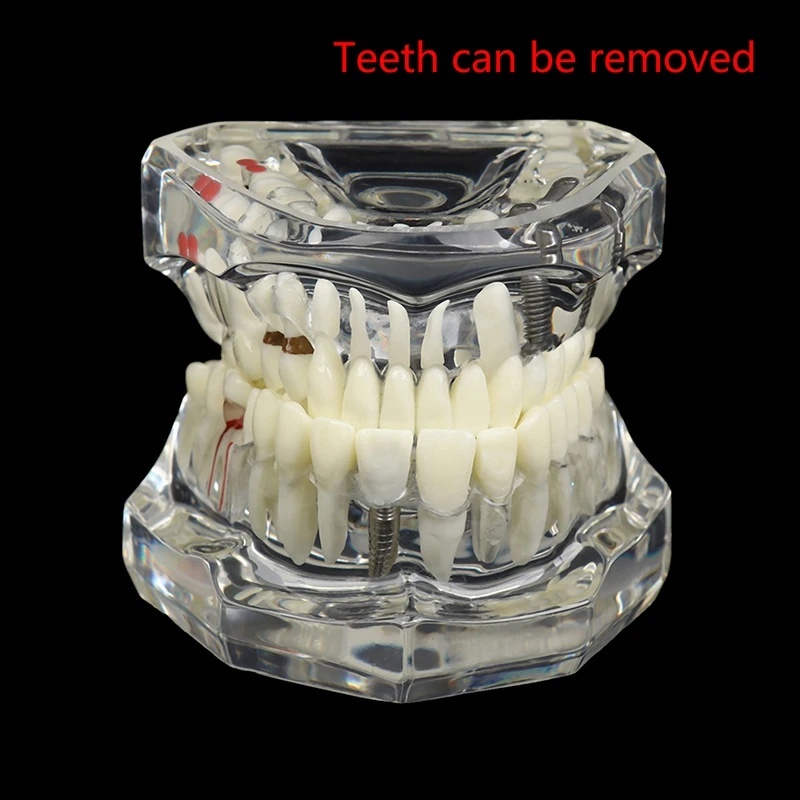 Jual Model gigi edukasi transparan studi implant phantom crown karies ...