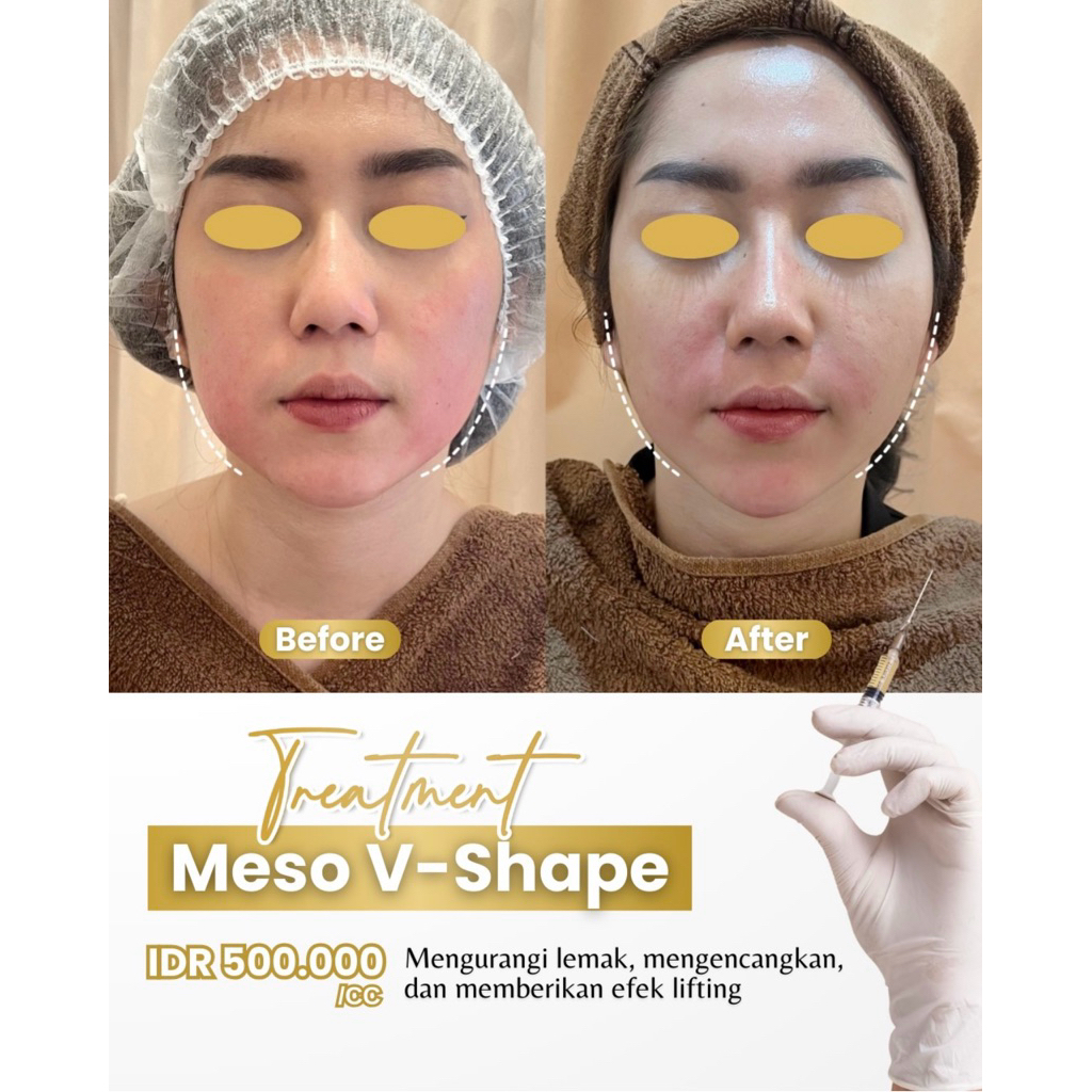 Jual meso treatment (glow, v shape, burner) | Shopee Indonesia