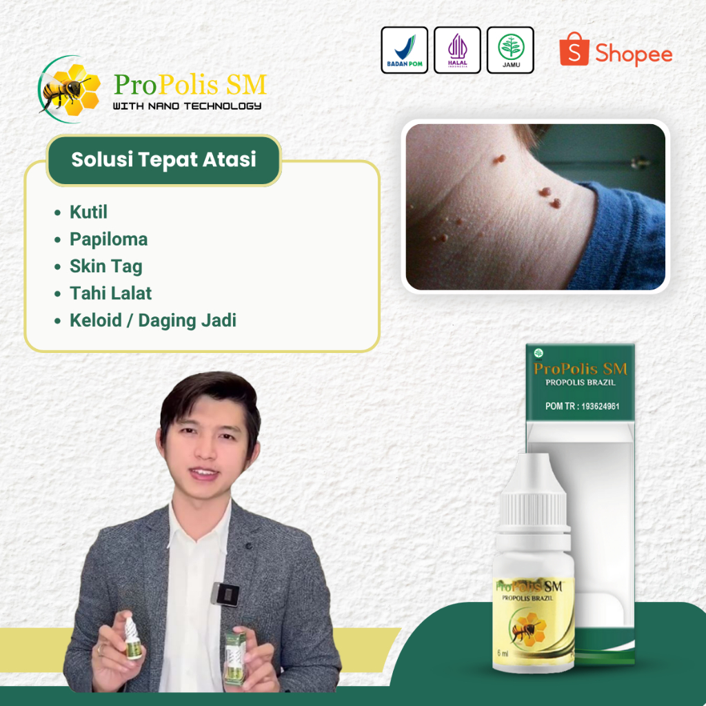 Jual Obat Perontok Kutil, Obat Penghilang Papiloma di Leher dan Wajah ...