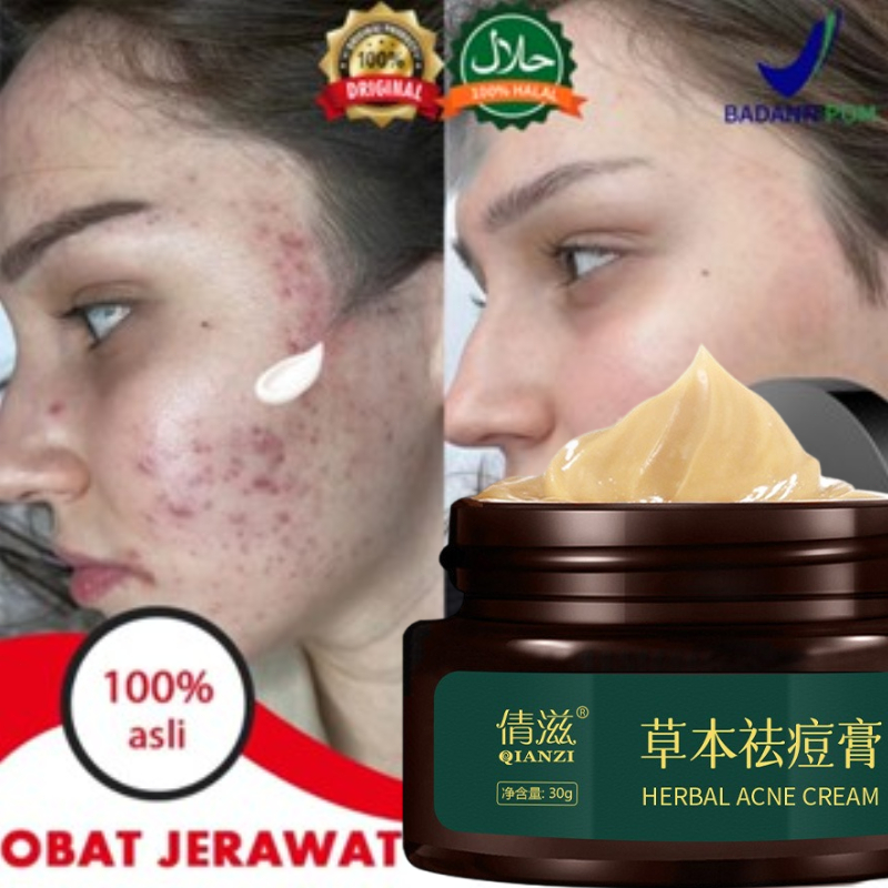 Jual Obat jerawat dan bekas jerawat penghilang salep obat paling ampuh ...