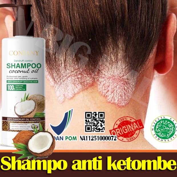 Jual Shampo anti ketombe Sampo anti gatal and ketombe Anti dandruff shampoo 500ml Obat Ketombe ...