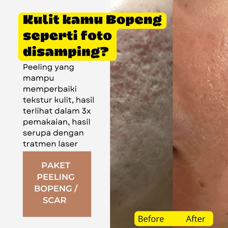 Jual Peeling Bopeng scar pori besar kerutan bisa halus seperti dilaser ...