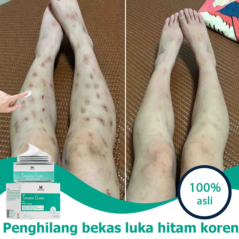 Jual 【BPOM】Obat penghilang bekas luka salep luka bakar obat koreng ...