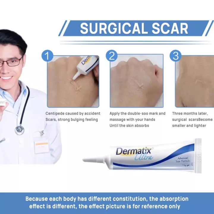 Jual Dermatix Ultra Advanced Scar Formula Gel / Salep Penghilang Bekas ...