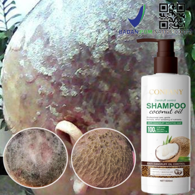 Jual Shampo Anti Ketombe BPOM Sampo Coconut Oil Sampo Anti Gatal Penghilang Ketombe Shampo ...