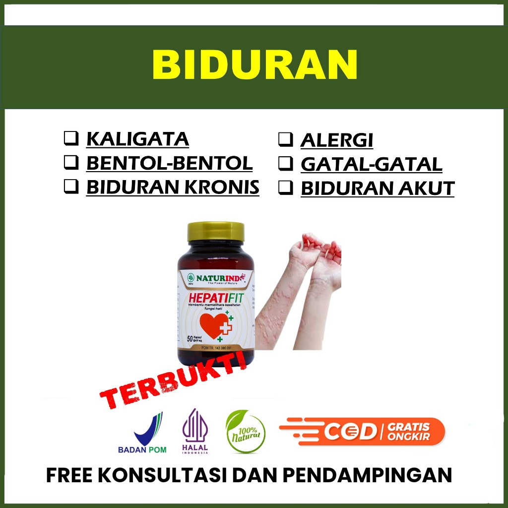 Jual Biduran Kaligata Alergi Gatal Gatal Biduran Akut Kronis Menahun ...