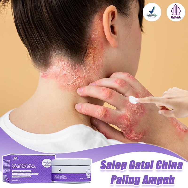 Jual salep eksim kering paling ampuh obat eksim 0bat gatal gatal kulit ...