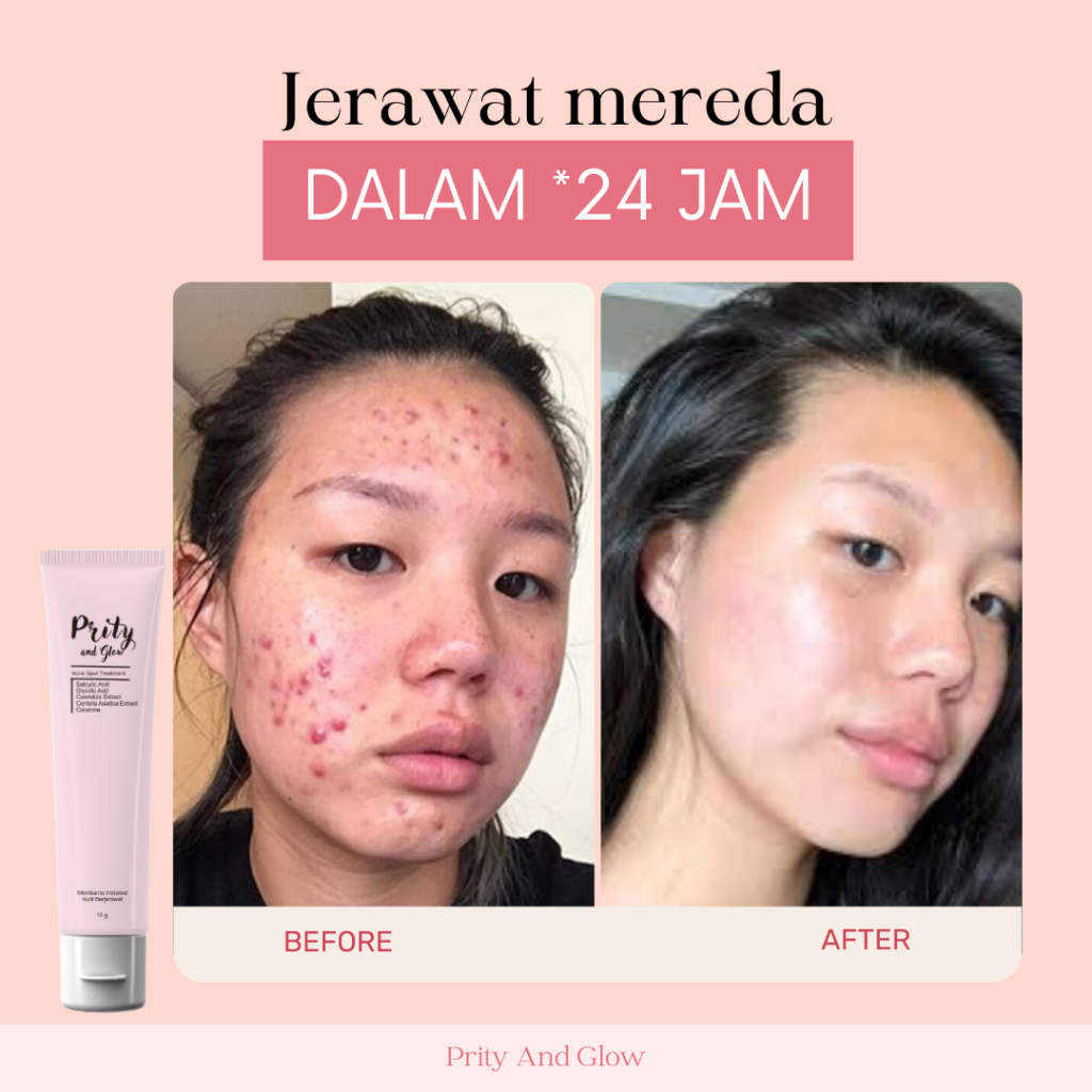 Jual PRITY AND GLOW - ACNE SPOT GEL OBAT TOTOL JERAWAT PENGHILANG BEKAS JERAWAT MERAH HITAM ...