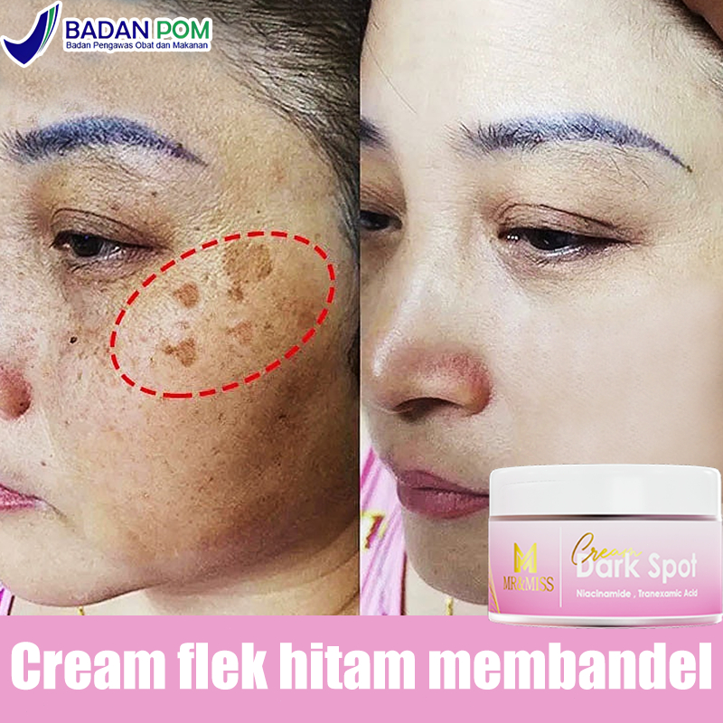 Jual Cream flek hitam membandel bpom Menghilangkan flek hitam di wajah Salep flek hitam ...