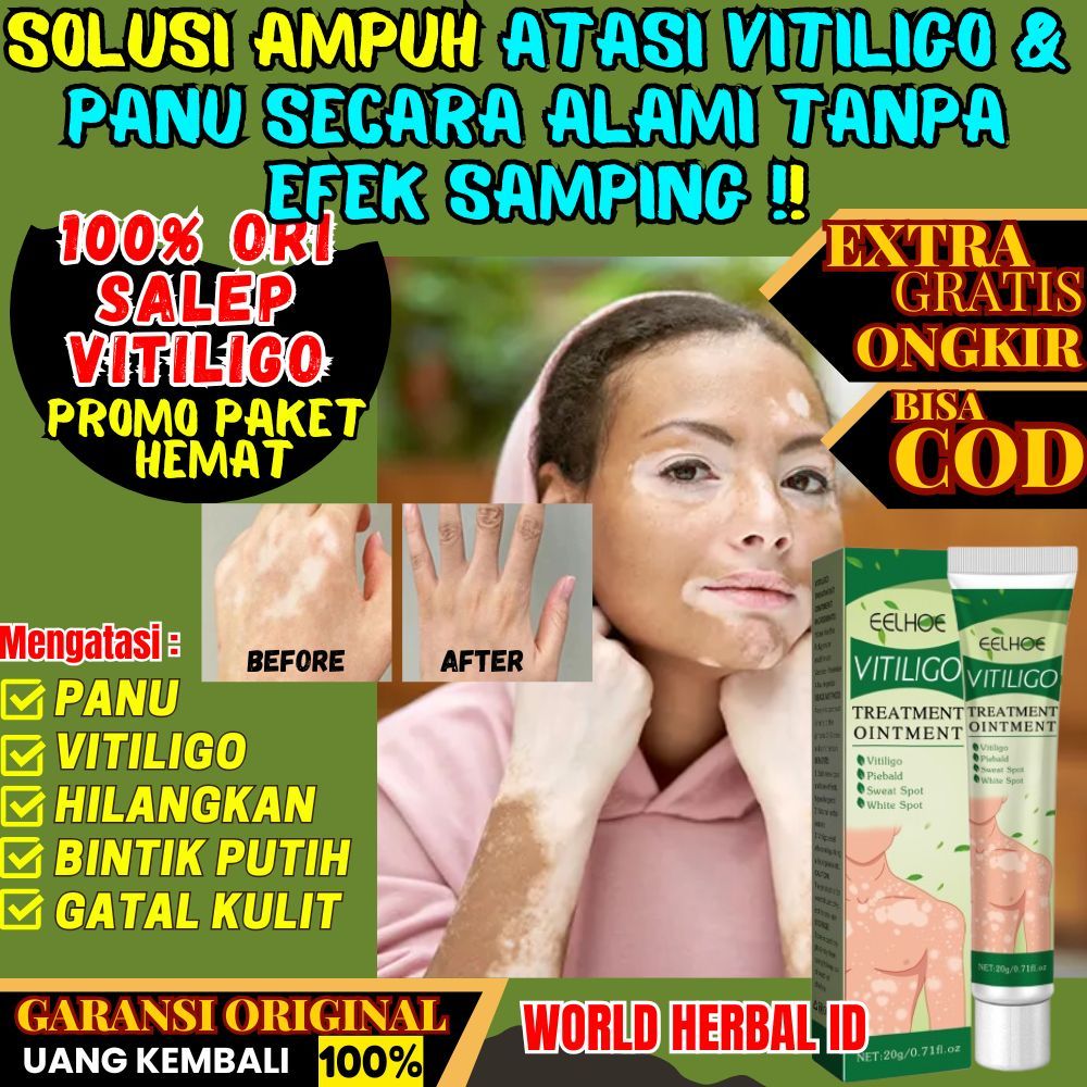Jual TIANGE SALEP HERBAL VITILIGO AMPUH ATASI MASALAH KULIT PANUAN ...