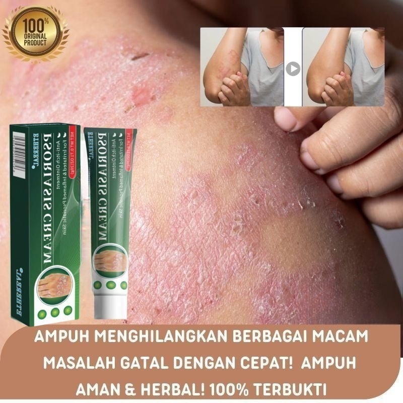 Jual Krim Psoriasis / Salep Gatal Paling Efektif 20g / Psoriasis Cream ...