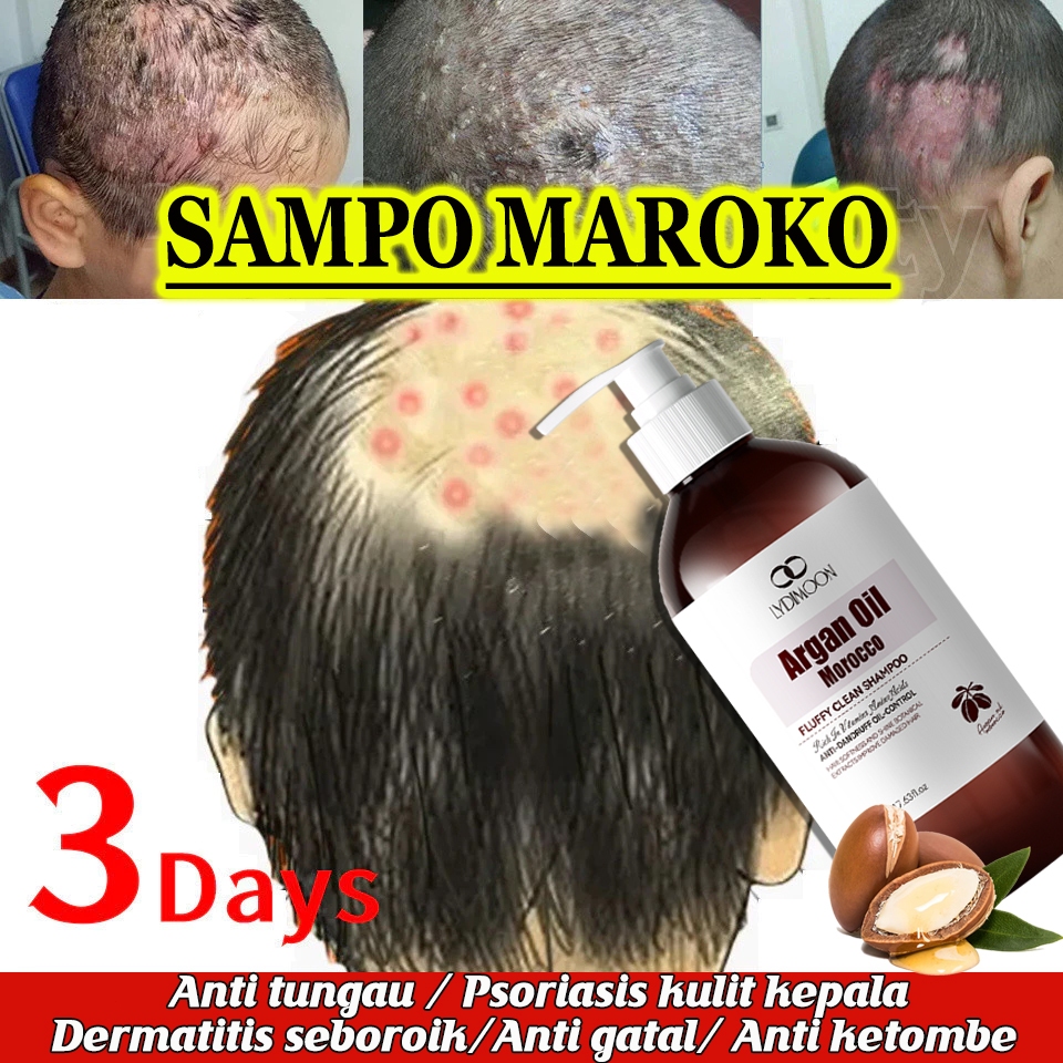 Jual Sampo anti gatal and ketombe 500ml Bersihkan kulit kepala secara mendalam untuk ...