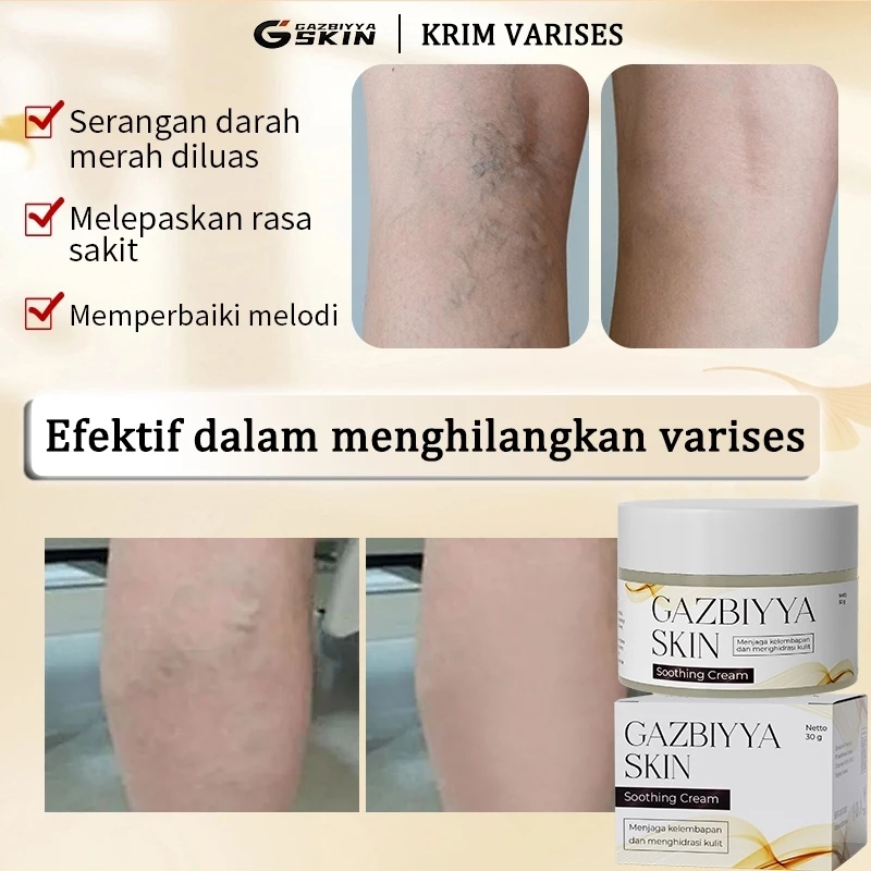 Jual ISA Valesin varises Obat varises Salep varises paling ampuh 30g ...