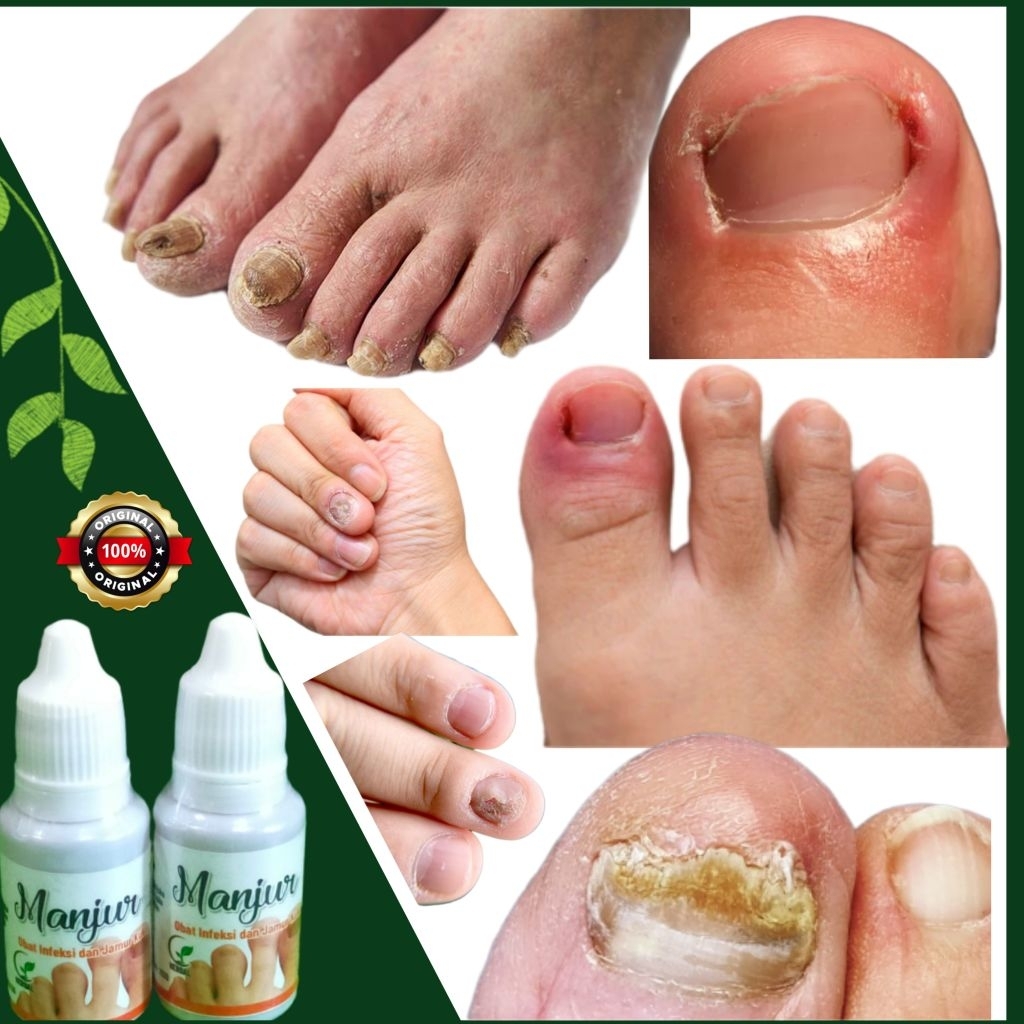 Jual obat kuku infeksi jamur dan bakteri bau gatal sakit bengkak ...