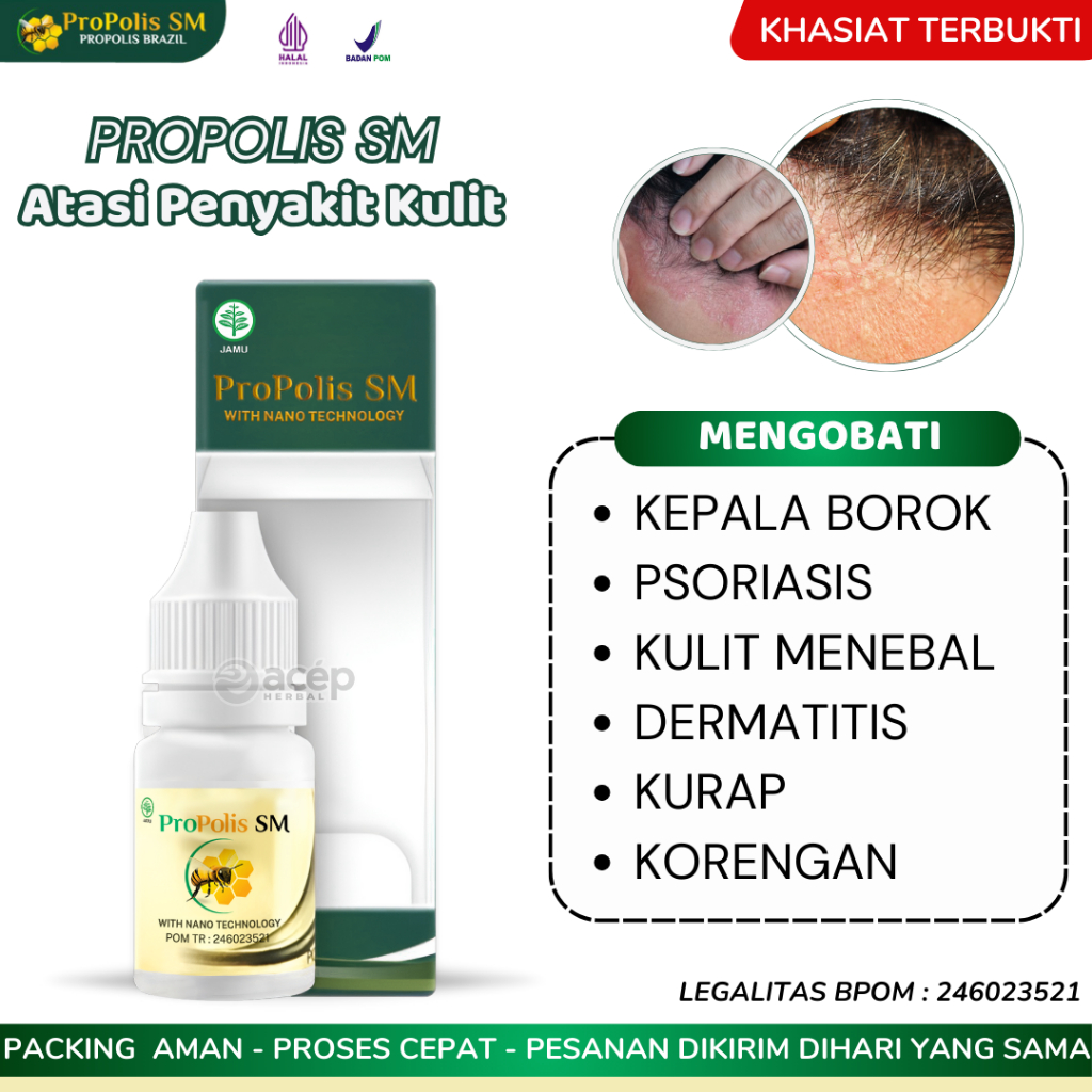 Jual Obat Kepala Borok, Kulit Kepala Berkerak Dan Bersisik, Ketombe Parah, Korengan, Infeksi ...