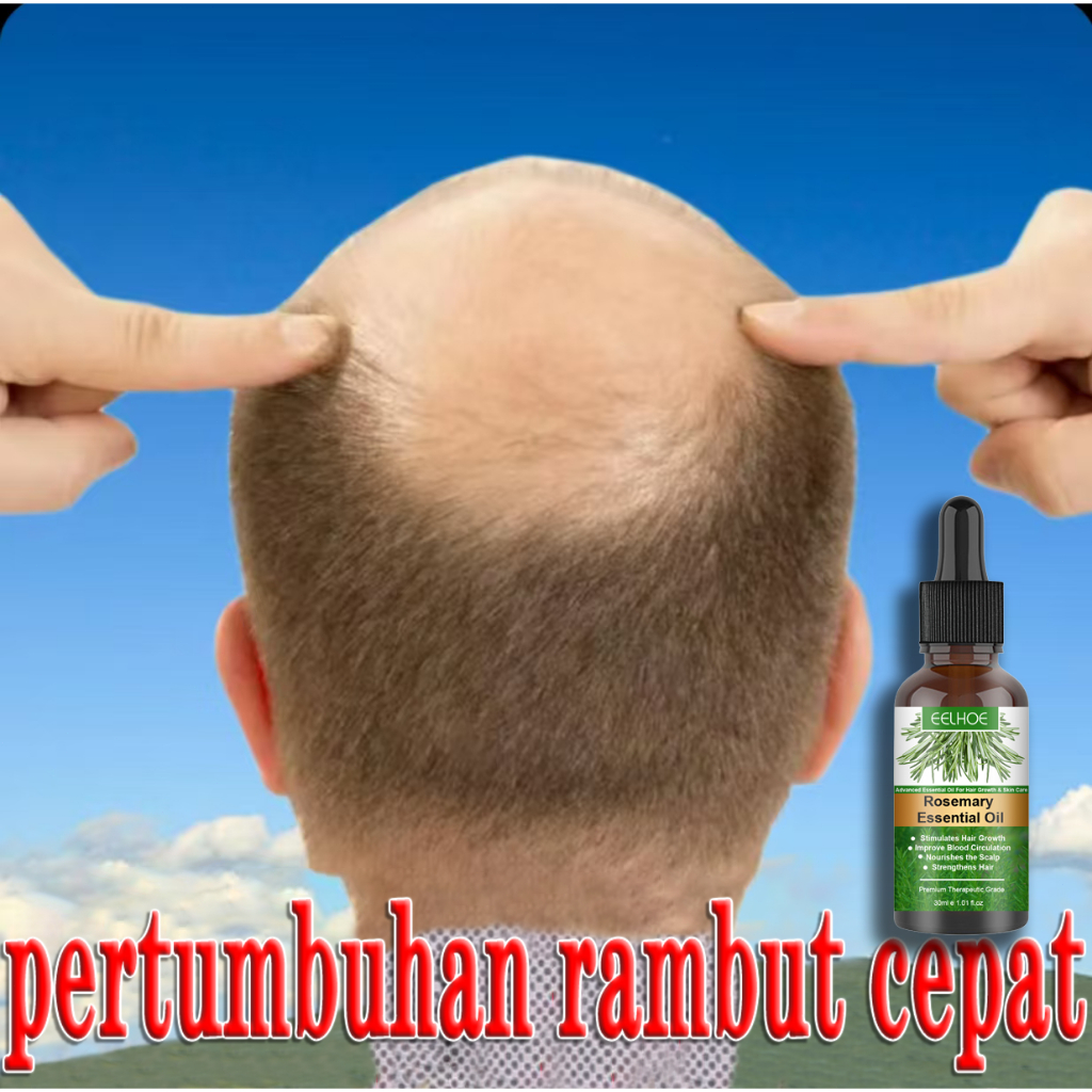 Jual Rosemary oil rambut penumbuh rambut botak Penebal rambut penumbuh ...