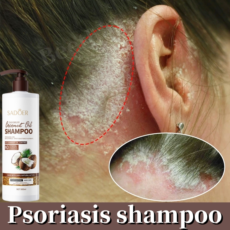 Jual shampoo anti ketombe Penghilang psoriasis dan ketombe berkerak Oil ...