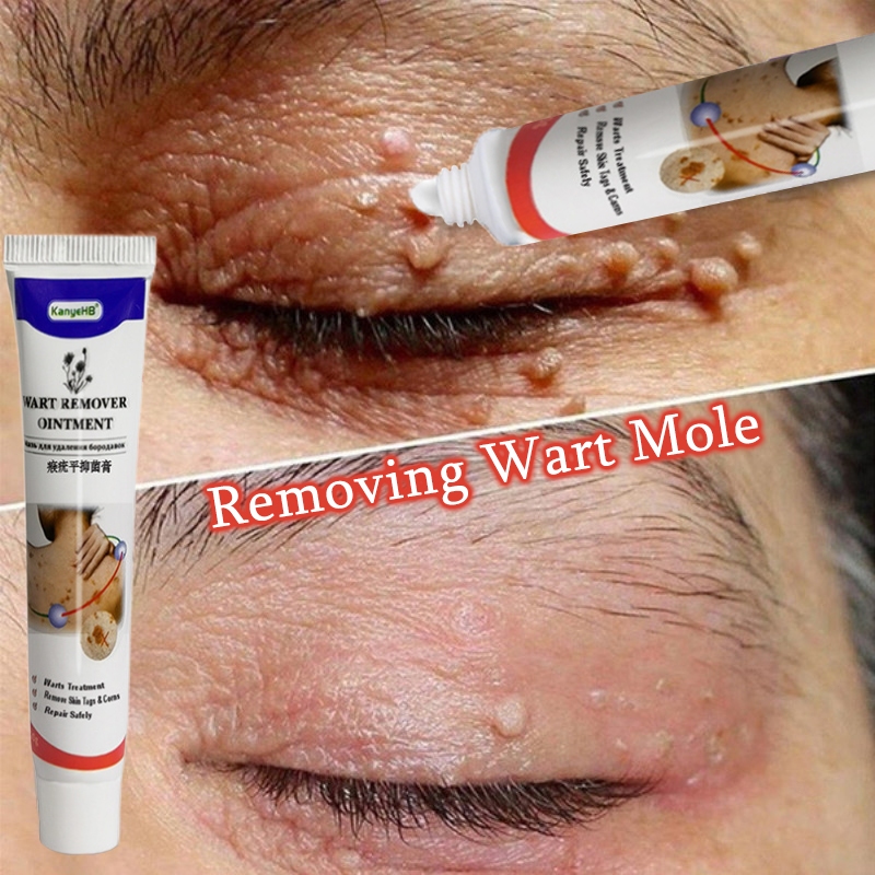 Jual Obat penghilang kutil Obat kutil kelamin Obat mata ikan Salep ...