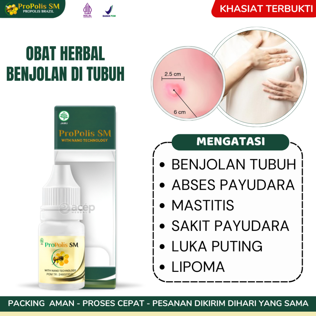 Jual Obat Oles Benjolan, Benjolan Di Payudara, Benjolan Lemak, Lipoma ...