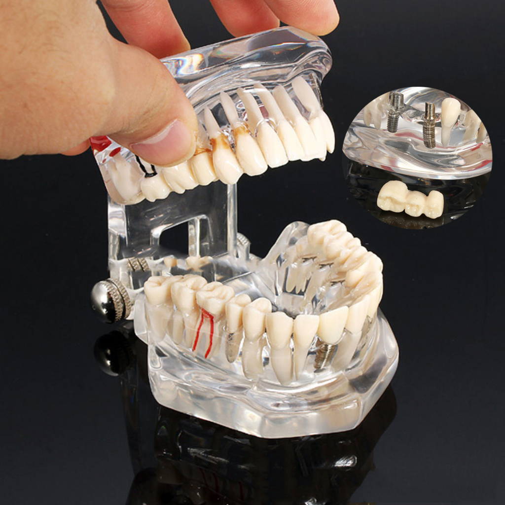Jual Model Gigi Edukasi Transparan Typodont Studi Implant Phantom Crown ...
