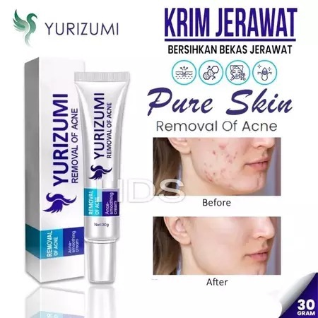 Jual Cream Jerawat Paling Ampuh Menghilangkan Jerawat / Removal of Acne ...