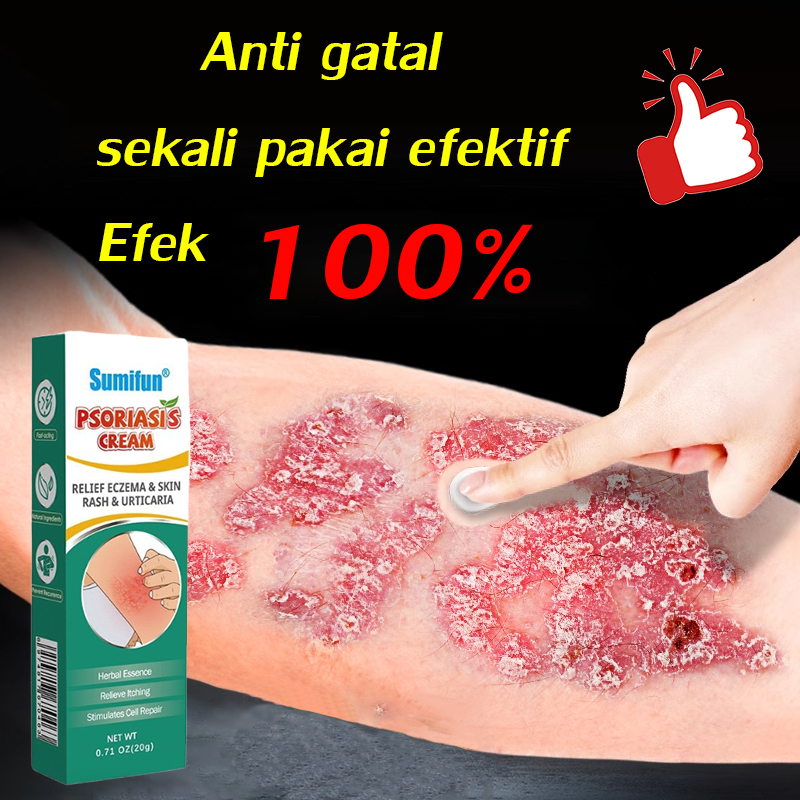 Jual Psoriasis cream 20g Herbal Cream Anti Gatal Sekali Pakai Efektif ...