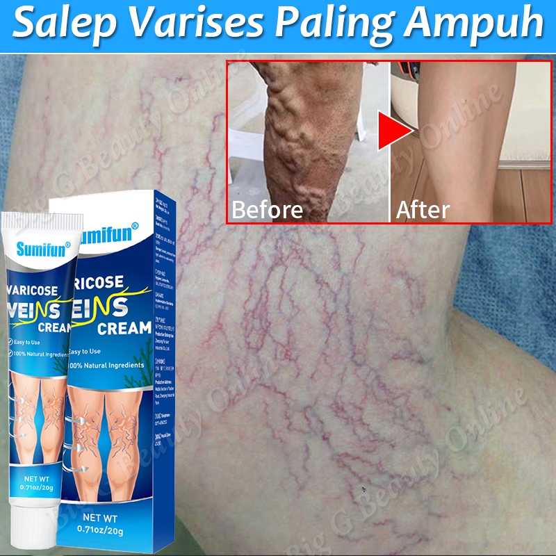 Jual Varicose Veins Cream Salep Varises Paling Ampuh Original Obat ...