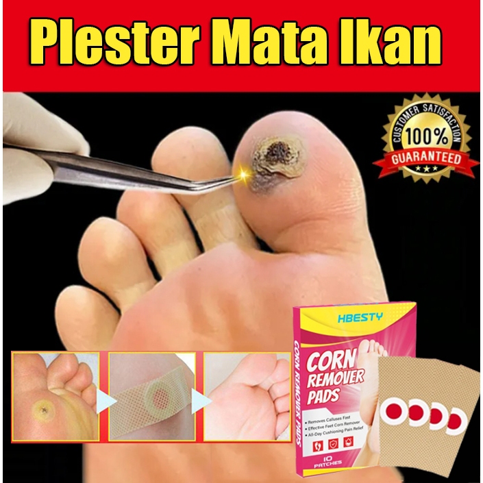 Jual Plester Mata Ikan Paling Ampuh Plester Kutil Patch Penghilang ...