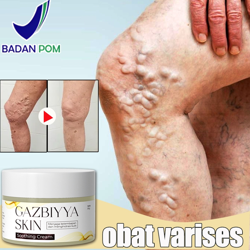 Jual Obat varises Salep varises Salep varises paling ampuh Obat ...