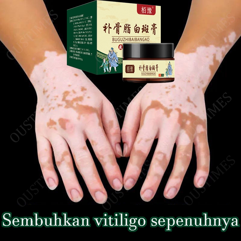 Jual Salep vitiligo membantu pertumbuhan melanin , Krim vitiligo ...