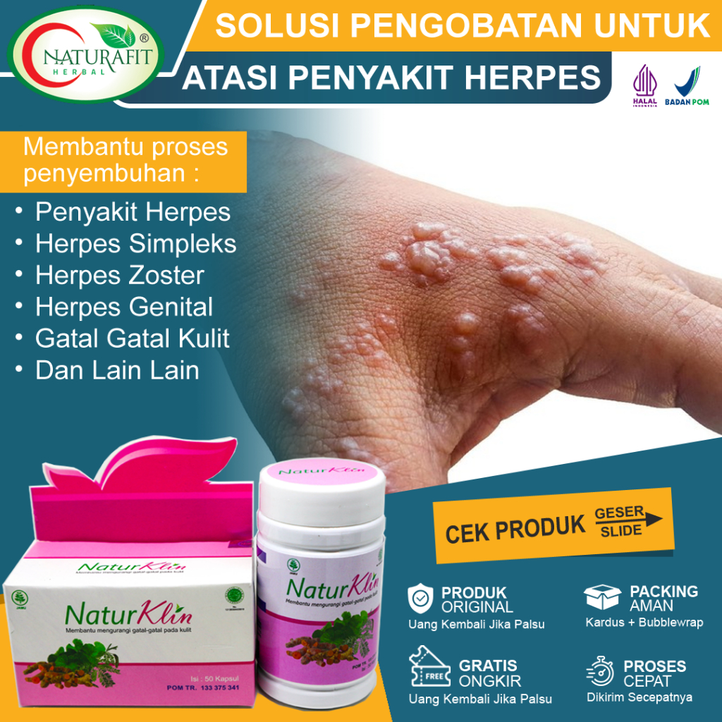 Jual Obat Herpes Paling Ampuh Gatal Gatal Herpes Kulit Zoster Genital ...