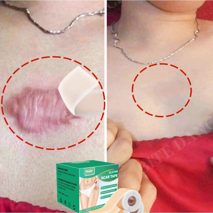Jual Silicone scar sheet Penghilang keloid Penghilang bekas luka hitam ...