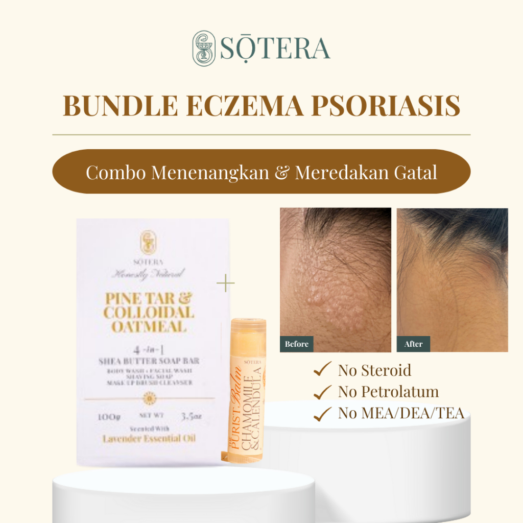 Jual Sotera Bundle Eczema Psoriasis | Menenangkan dan meredakan gatal akibat eksim dan psoriasis ...