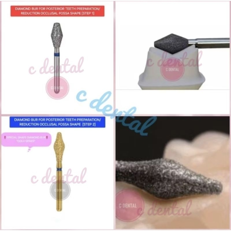 Jual Dental Posterior OccluShaper Occlusal Diamond Bur Reduksi Oklusal ...