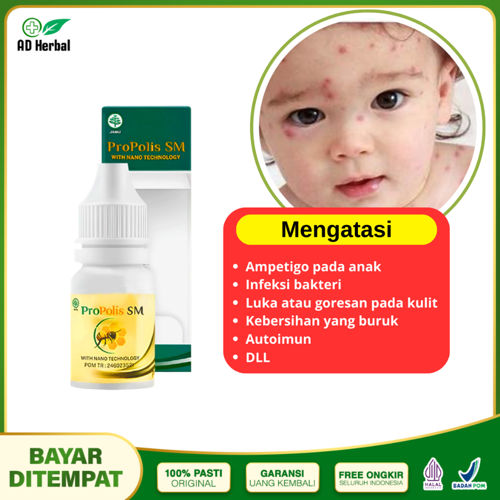 Jual Obat Impetigo Anak, Penghilang infeksi kulit Ruam Merah Pada Anak ...