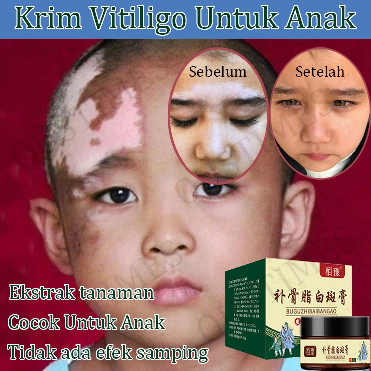 Jual Salep khusus vitiligo Untuk Anak 20g Krim bintik putih /obat ...