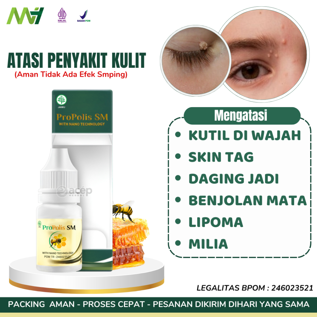 Jual Obat Tetes Kutil, Penghilang Kutil Di Wajah, Skin Tag, Bruntusan ...