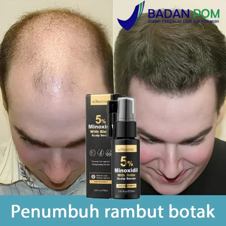 Jual Minoxidil Penumbuh Rambut serum Obat Penumbuh Rambut Botak Tipis ...