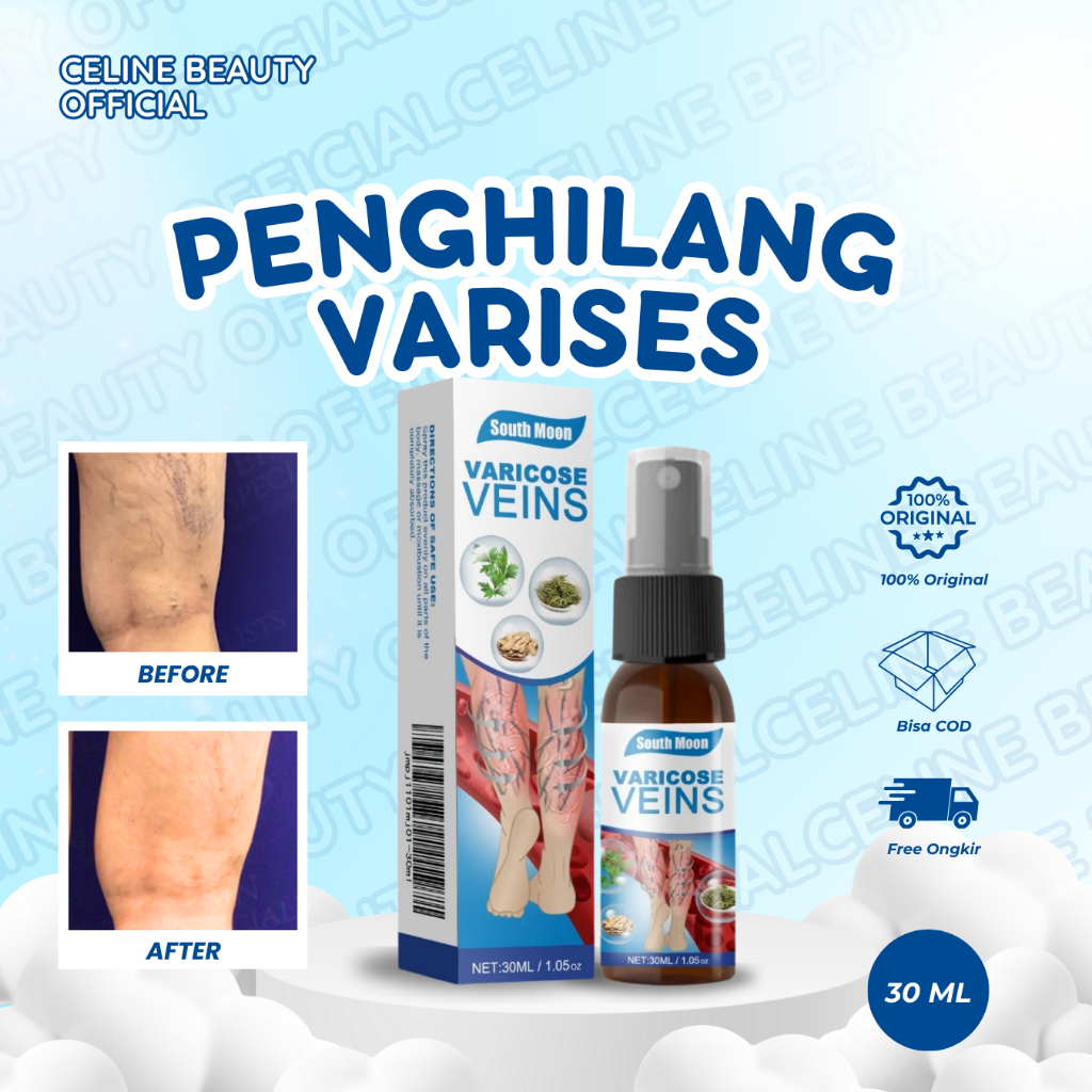 Jual Varicose Veins Obat Varises Spray Penghilang Varises Greenery ...