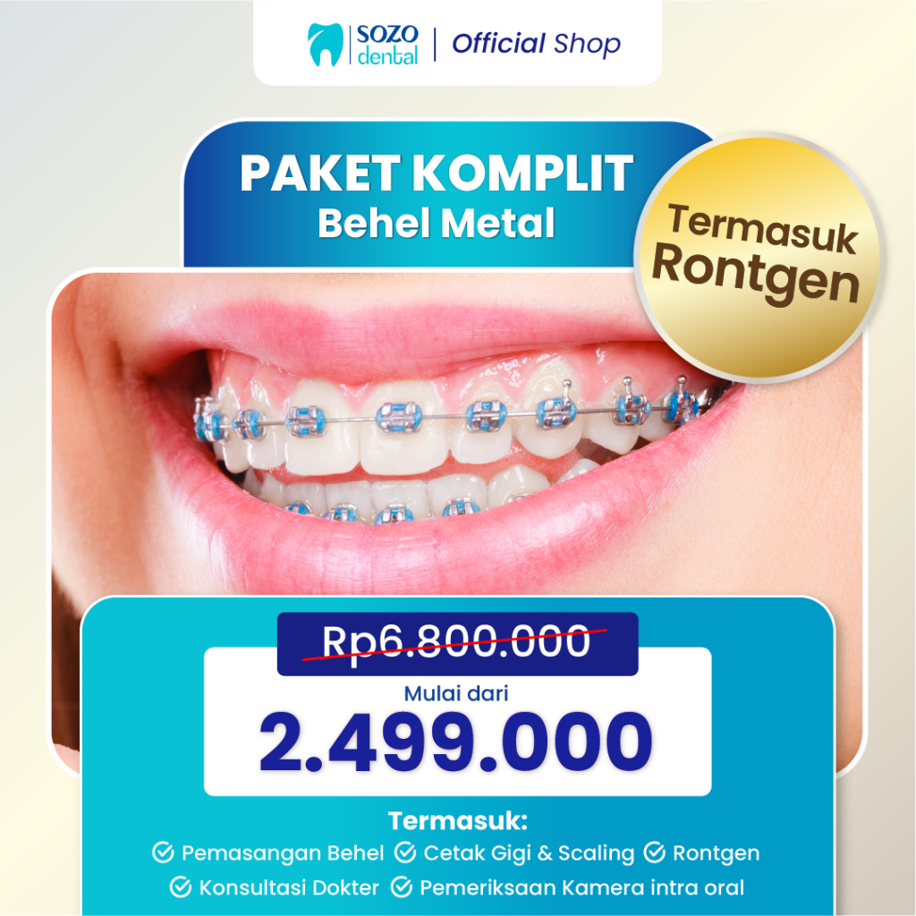 Jual Paket Behel Metal Basic Komplit: Pemasangan Rahang Atas dan Bawah ...