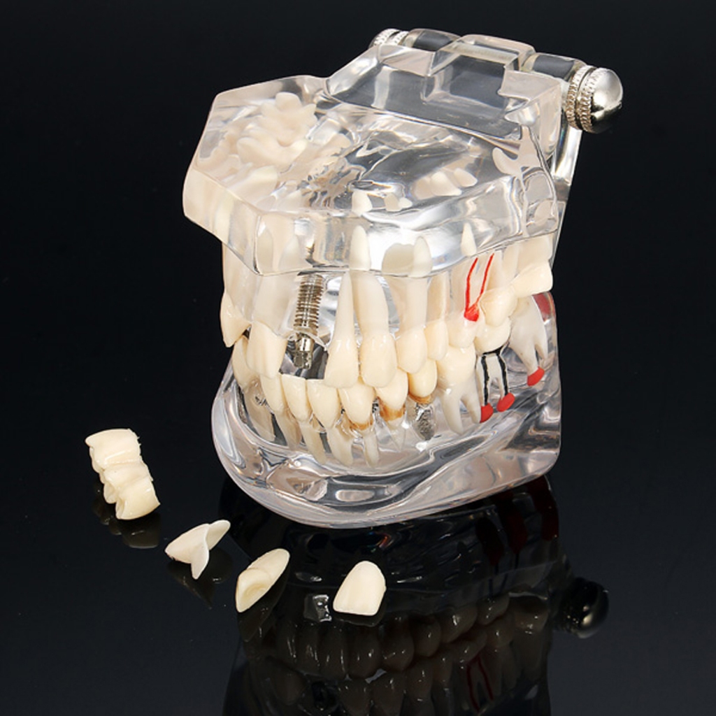 Jual Model gigi / Removable Teeth Model /Implant Disease Study Model ...