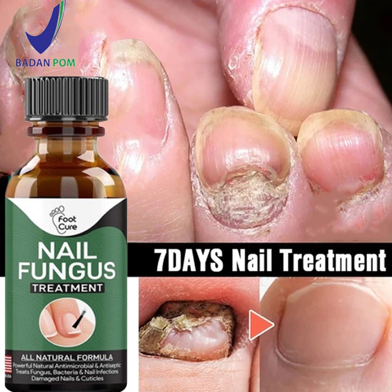 Jual Nail repair serum perawatan kuku jamur rusak dan cantengan kaki ...